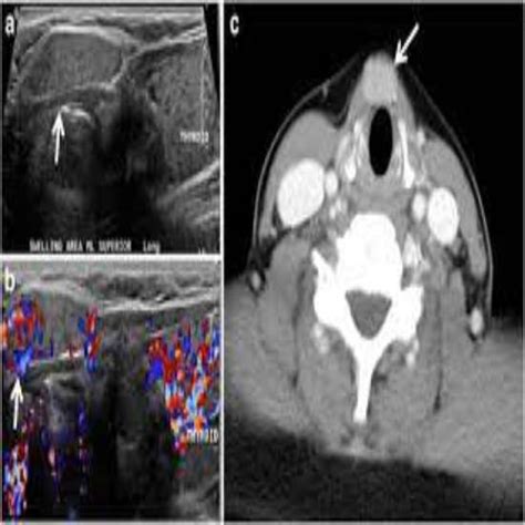 Thyroid Color Doppler What It Is Purpose Procedure And Results