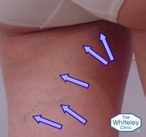 What Are Vulval Vaginal Varicose Veins