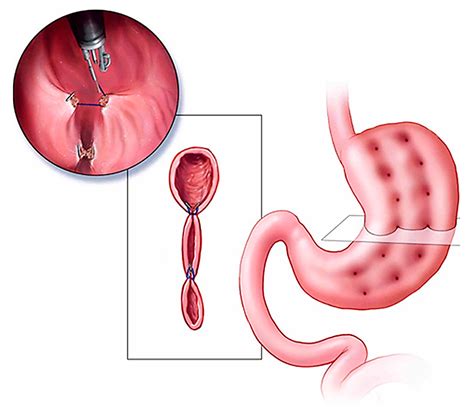 Gastric Sleeve Surgery Cost That You Need To Pay