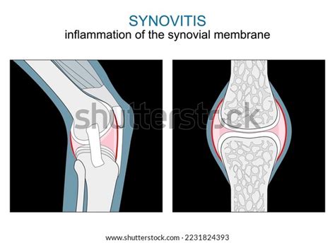 Types Synovitis Inflammation Synovial Membrane Knee Stock Vector