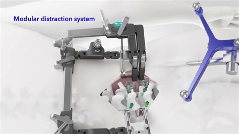 Medtronic Cd Horizon ™ Modulex™ 5 5mm Spinal System Youtube