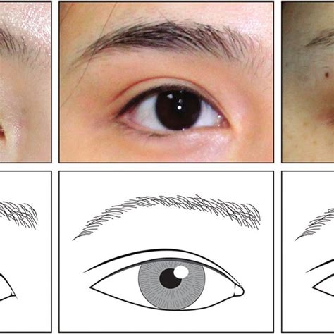 Monolid Eyes Epicanthal Folds Causes Atelier Yuwaciaojp