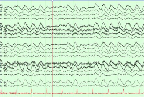 Eeg Nowyouknow Neuro