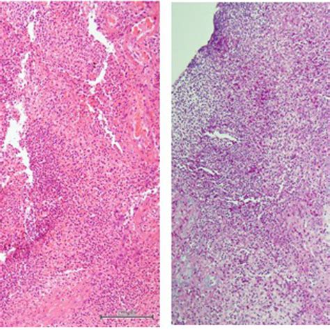 Histologic Specimen Shows A Non Caseating Granulomatous Inflammation Download Scientific