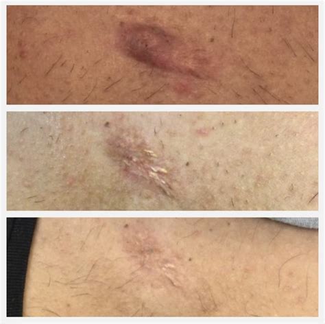 5 Fluorouracil And Triamcinolone Treatment For Keloid Scars London