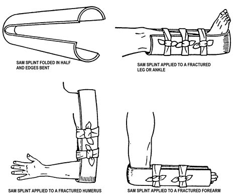 How To Use A Sam Splint To Treat Bone Fractures Worst