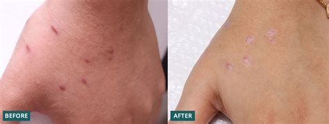 Keloid Scalp Keloids Keloid Removal Expert New York