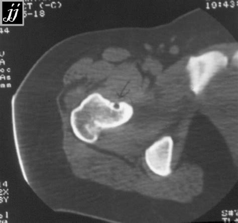 Msk Femoral Neck Cortical Cyst Radioogle