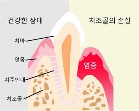 치주질환 증상 있으면 즉시 치료해야