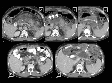 Clasificación De Balthazar En La Pancreatitis Aguda Concentra