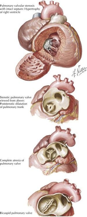 Tricuspid And Pulmonic Valve Disease Thoracic Key