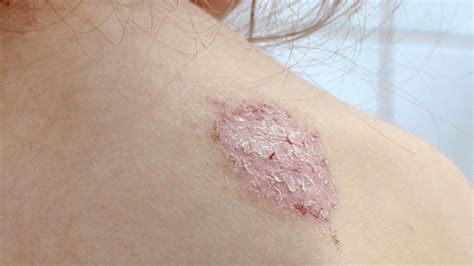7 Macam Dermatitis Yang Perlu Diketahui Beserta Gambarnya