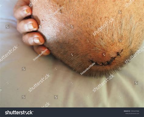 What Sutures To Use For Head Laceration At Donald Zielinski Blog