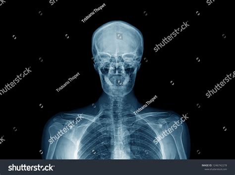 8478 Xray Arm 이미지 스톡 사진 및 벡터 Shutterstock