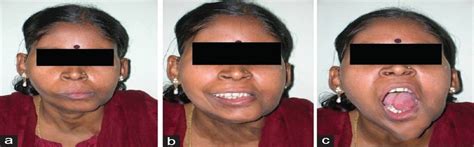Prosthetic Management Of A Hemi Mandibulectomy Patient Indian Journal Of Dental Sciences