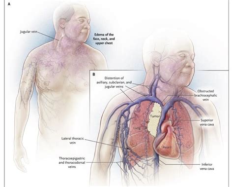 What Is Lung Cancer Symptoms Signs And More Via Pritish