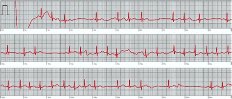 Tachycardia Atrial Fibrillation Heart Rate 102 Beats Per Minute