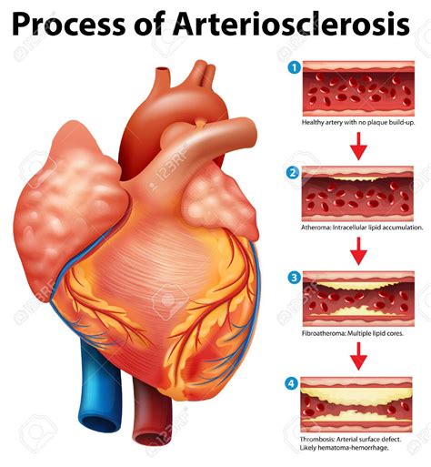 Arteriosklerosis