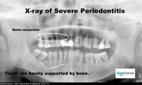 Severe Periodontitis Radiograph