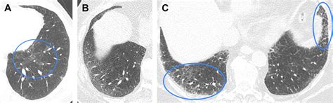 Interstitial Lung AbnormalityWhy Should I Care And What Should I Do