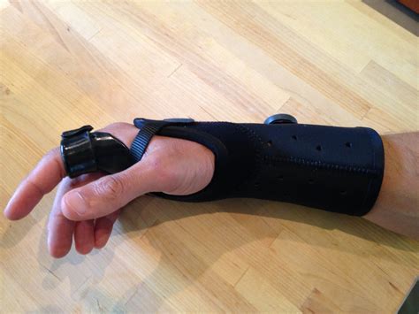 What Is A Serial Static Splint Dadneed