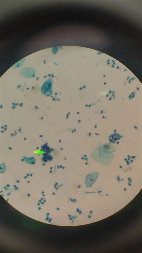 Lituo Carol On Linkedin Lbc Cervicalcancerscreening Lituobiotech Lituocarol