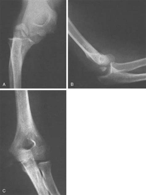 Elbow Dislocations Musculoskeletal Key
