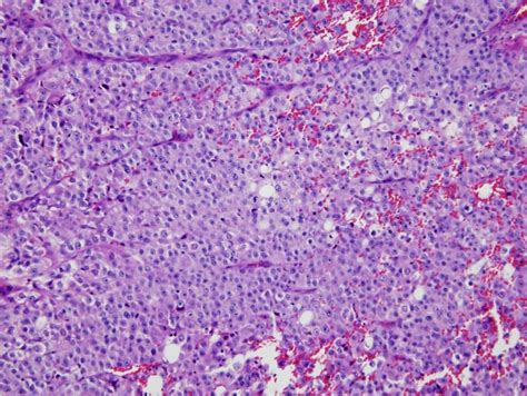 Malignant Primary Leydig Cell Tumor Testis Bosnianpathology