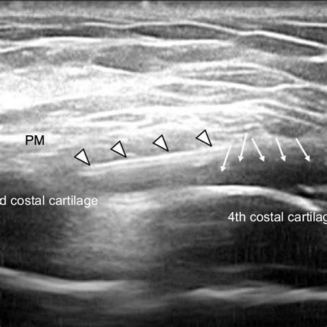 Ultrasound Image Of 2nd Injection Of Modified Pecs Ii Block Pectoralis