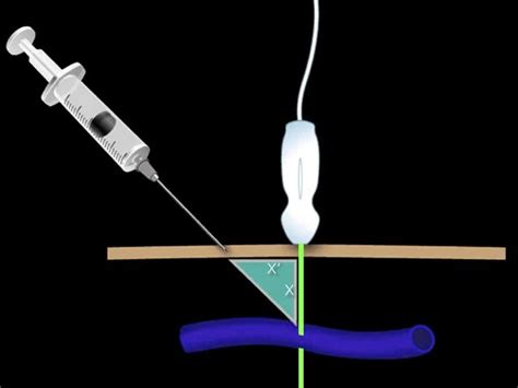 Peripheral Venous Access Procedures Procedure Visualization