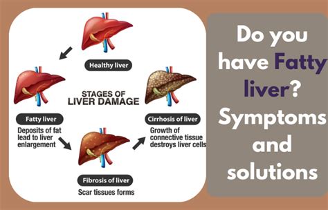Do You Have Fatty Liver Symptoms Solutions And Expert