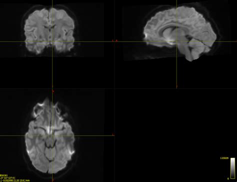 Csd On Dti Data With 30 Directions Mrtrix3 Community