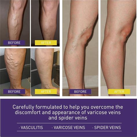 Varicose Veins Cream Spider Veins Repair Treatment For Legs Relief Ointment