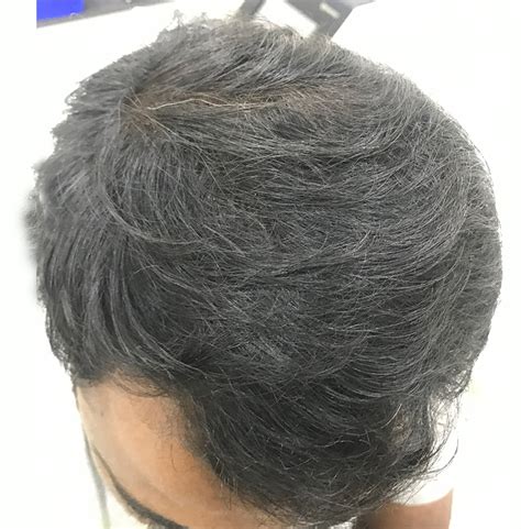 Best Skin And Hair Clinic In Chennai Dermatologist Skin Hair