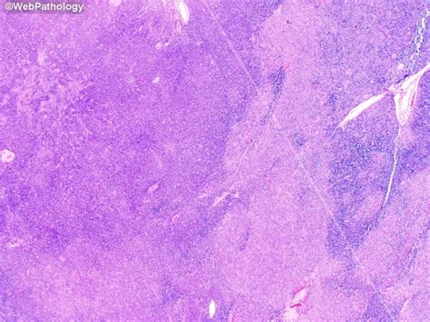Type Ab Thymoma Presentation