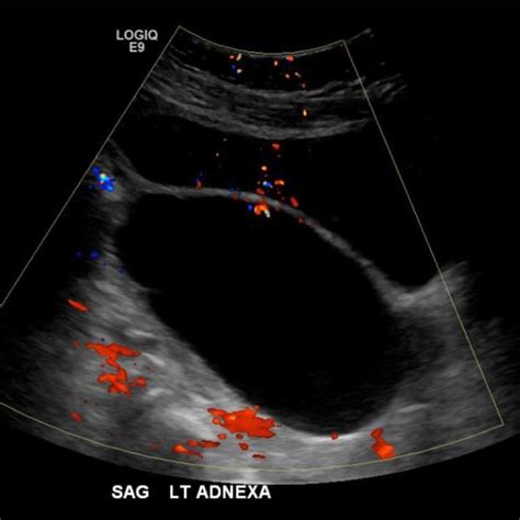 Sagittal View Of Left Adnexal Cyst Yellow Arrow On Ct Abdomen And Pelvis Download