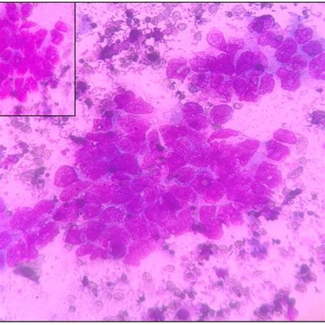 Distribution Of Transudate And Exudate On Cytological Examination Download Scientific Diagram