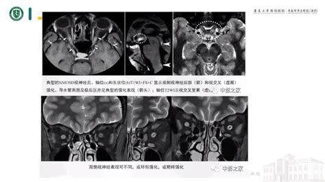 中国视神经脊髓炎谱系疾病诊断与治疗指南2021版）【幻灯版】 脑医汇