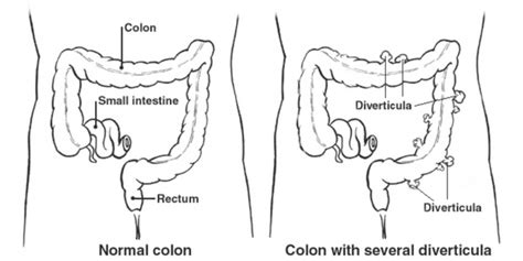 Best Doctor For Colorectal Treatment Yashoda Hospital
