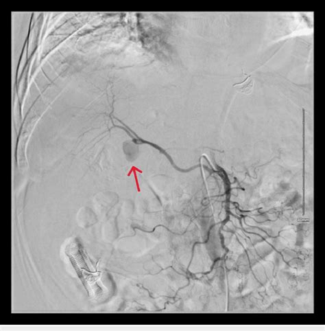 Angiography Before Embolization Showing A Cystic Artery Pseudoaneurysm