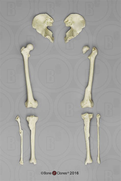 Human Fracture Set Fm 501 Set Bone Clones Inc Osteological