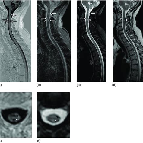 A 32 Year Old Woman With Relapsing Remitting Multiple Sclerosis Download Scientific Diagram