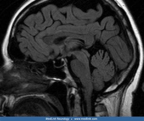 Pituitary Apoplexy Medlink Neurology