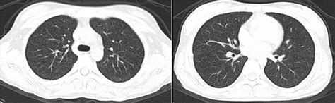 Representative Slices Of Chest Ct Images Showed Diffuse Miliary Nodules