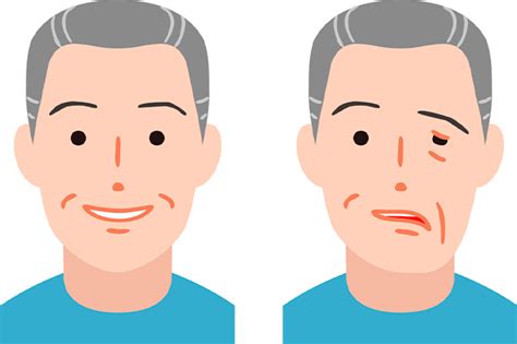 Qué Es Y Cómo Podemos Identificar Una Parálisis Facial A Tiempo