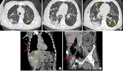 A Three Panel Axial Chest Ct Demonstrating Multiple Lung Nodules With