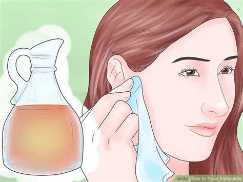 Ways To Treat Folliculitis WikiHow