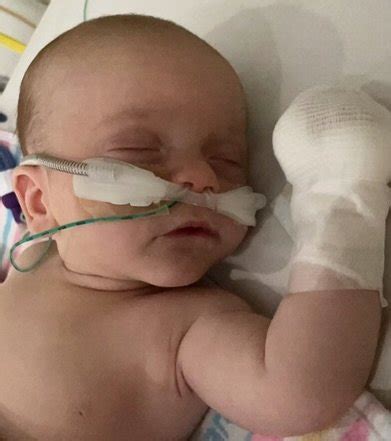 Unite Against RSV Signs And Symptoms Immunisation Foundation Of Australia