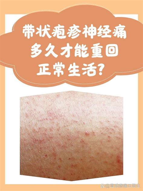 带状疱疹神经痛，多久才能重回正常生活？