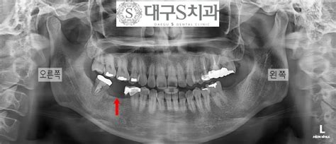 대구 성서 임플란트 잘하는치과 대구 이곡동 임플란트 보철 성서 친절한 치과 네이버 블로그
